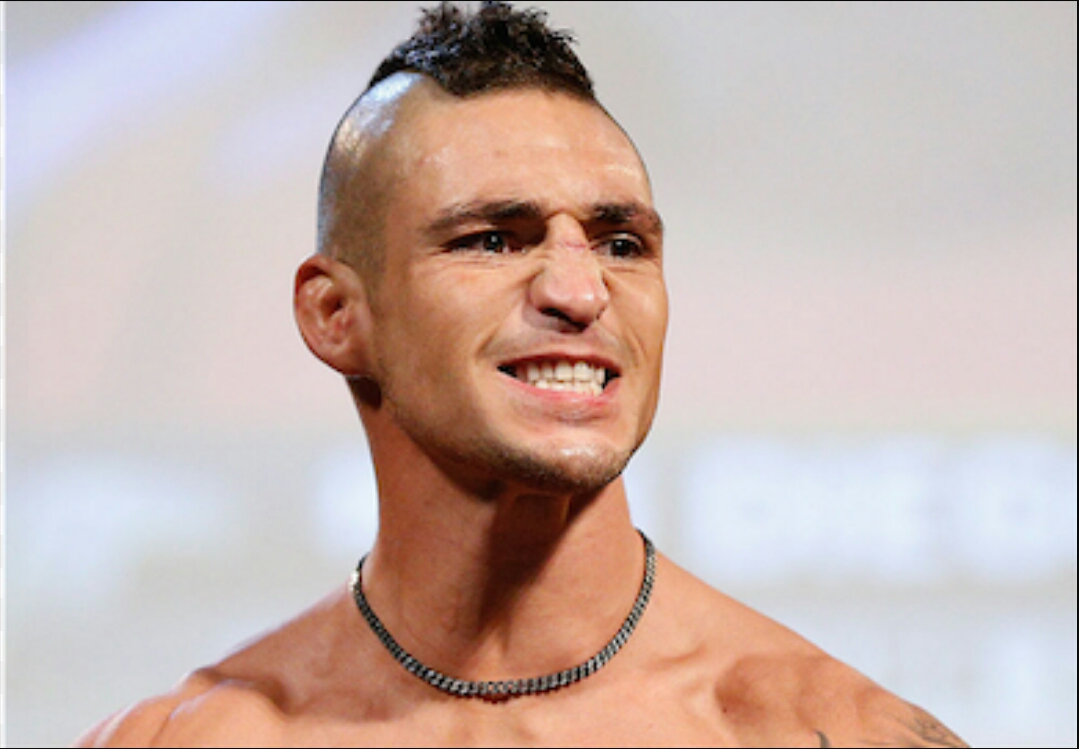 DIEGO SANCHEZ BROKEN COLLAR-BONE SURGERY PICTURE **WARNING GRAPHIC ...